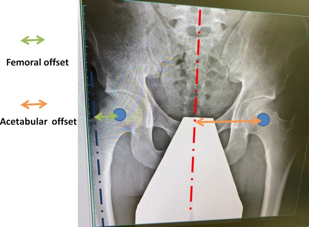 THAのoffsetってなに？ | わらディカル@理学療法のすすめ
